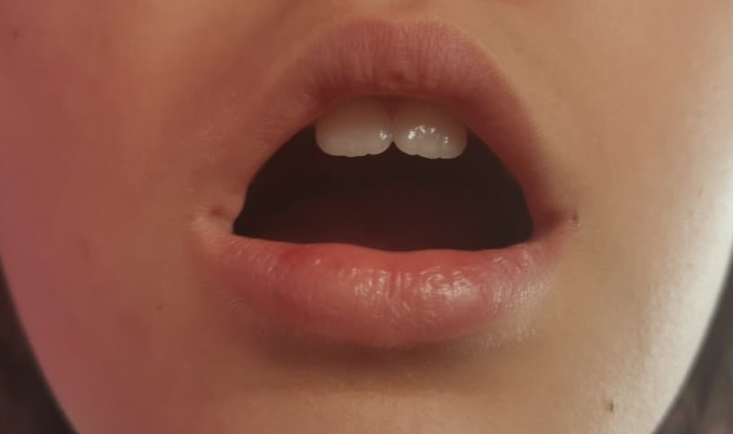 Halitoza - dr. aristide - dentist bun in Bucuresti