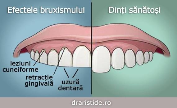 Bruxism. Simptome, cauze si tratament. - dr. aristide - dentist bun in ...
