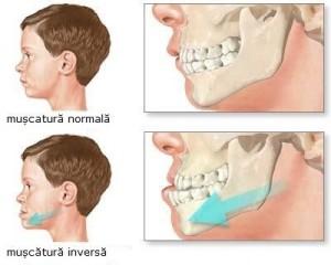 Muscatura inversa. Caracteristici. Tratament - dr. aristide - dentist ...