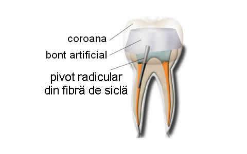 Fractura radiculară